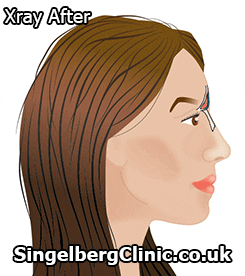 nvdd_01_Frontal_bossing-Xray-after - Singelberg kliniek
