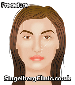 nvdd_02_Browlift-Procedure-front - Singelberg kliniek