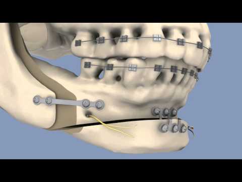 sagittal osteotomy sliding genioplasty - Singelberg kliniek